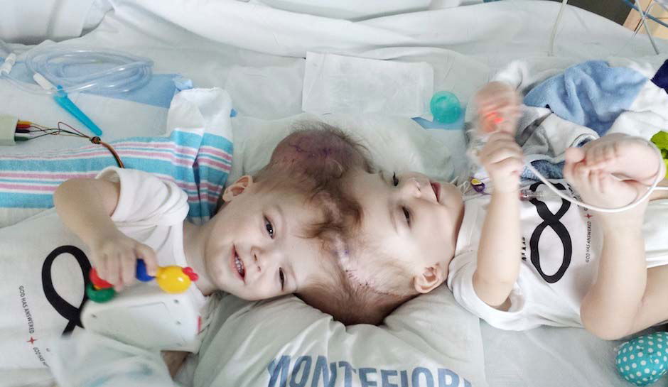 Adorable Moment Conjoined Twins Cuddling After Lifesaving Surgery ...