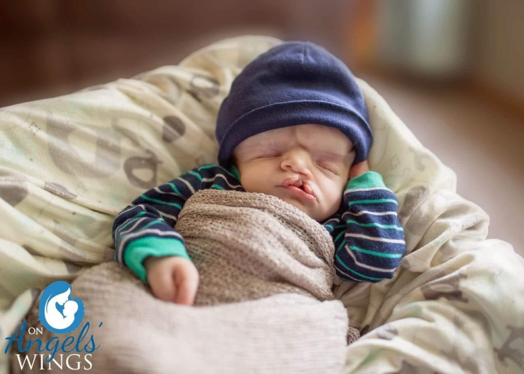 Baby Born Without Skull Defies Doctors And Celebrates First Birthday ...